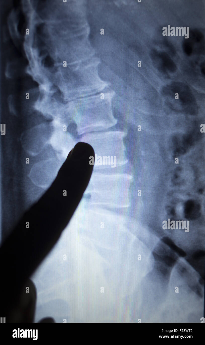 X-ray orthopedic medical CAT scan of painful lower back spine injury in ...