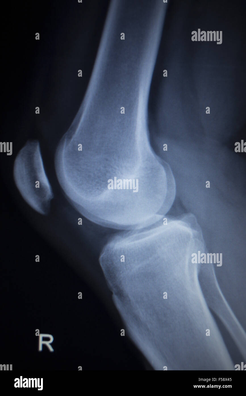 X-ray orthopedic medical CAT scan of painful knee meniscus injury leg ...