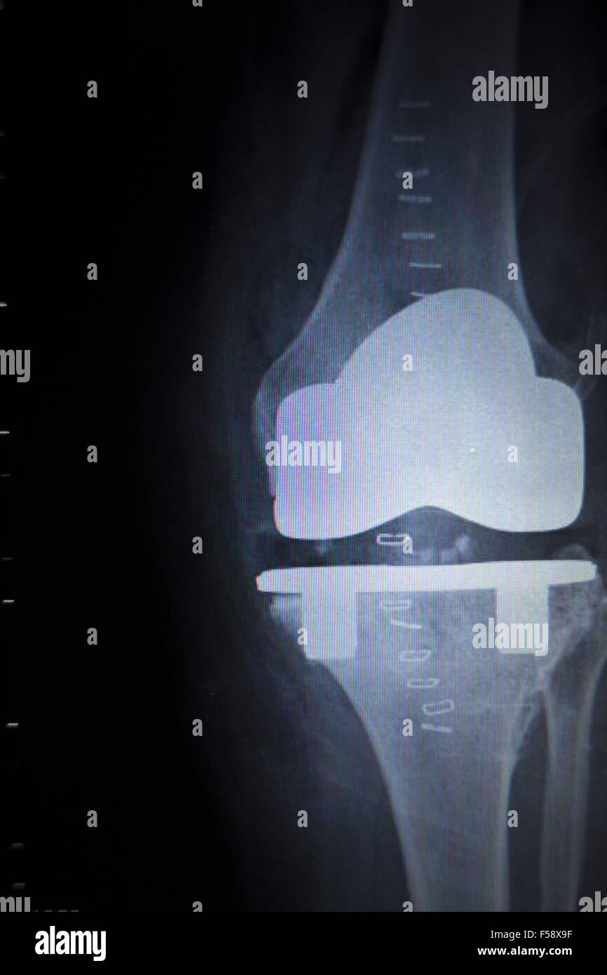 X-ray orthopedic medical CAT scan of painful knee meniscus injury leg ...