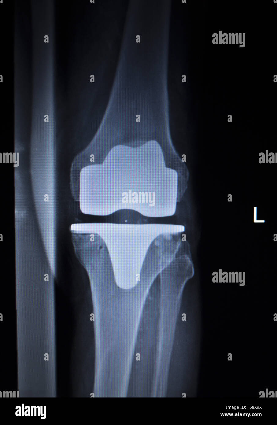 X-ray orthopedic medical CAT scan of painful knee meniscus injury leg ...