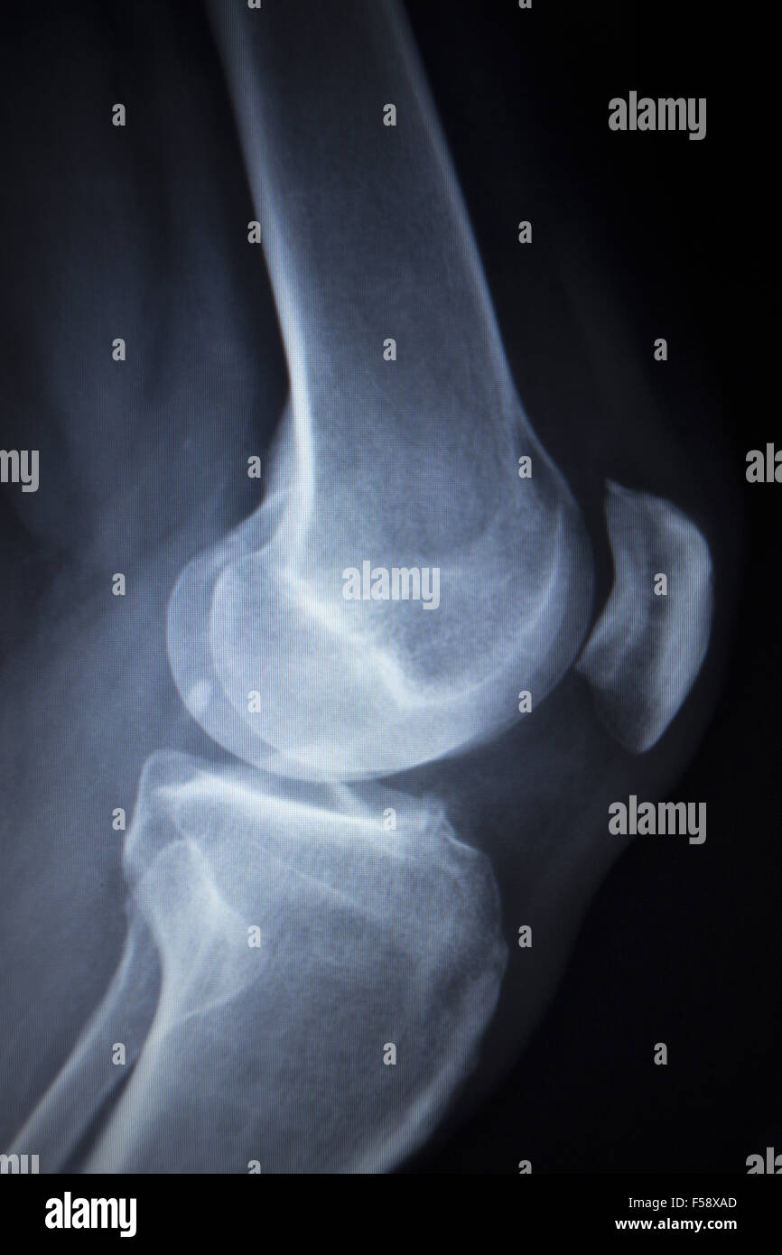 Cat scan knee hi-res stock photography and images - Alamy
