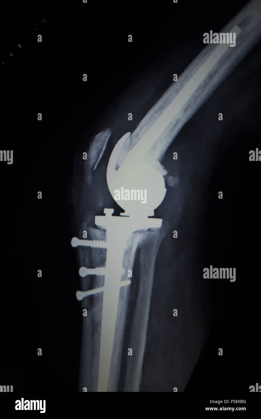 X-ray orthopedic medical CAT scan of painful knee meniscus injury leg ...
