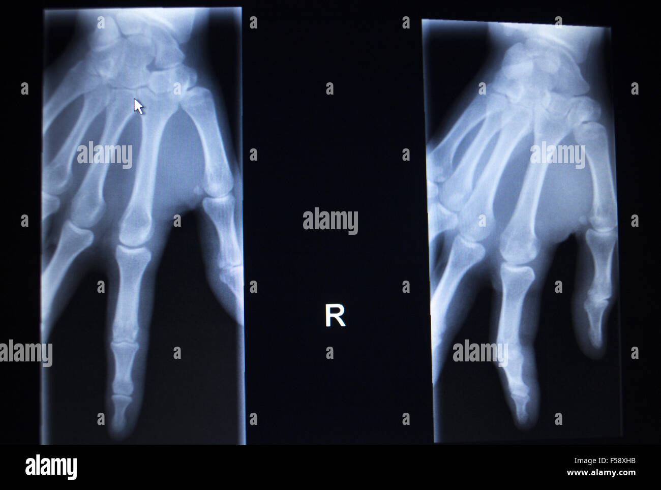 X-ray orthopedic medical CAT scan of painful hand fingers thumb injury ...