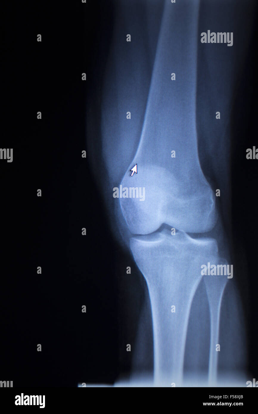 X-ray orthopedic medical CAT scan of painful knee meniscus injury leg ...