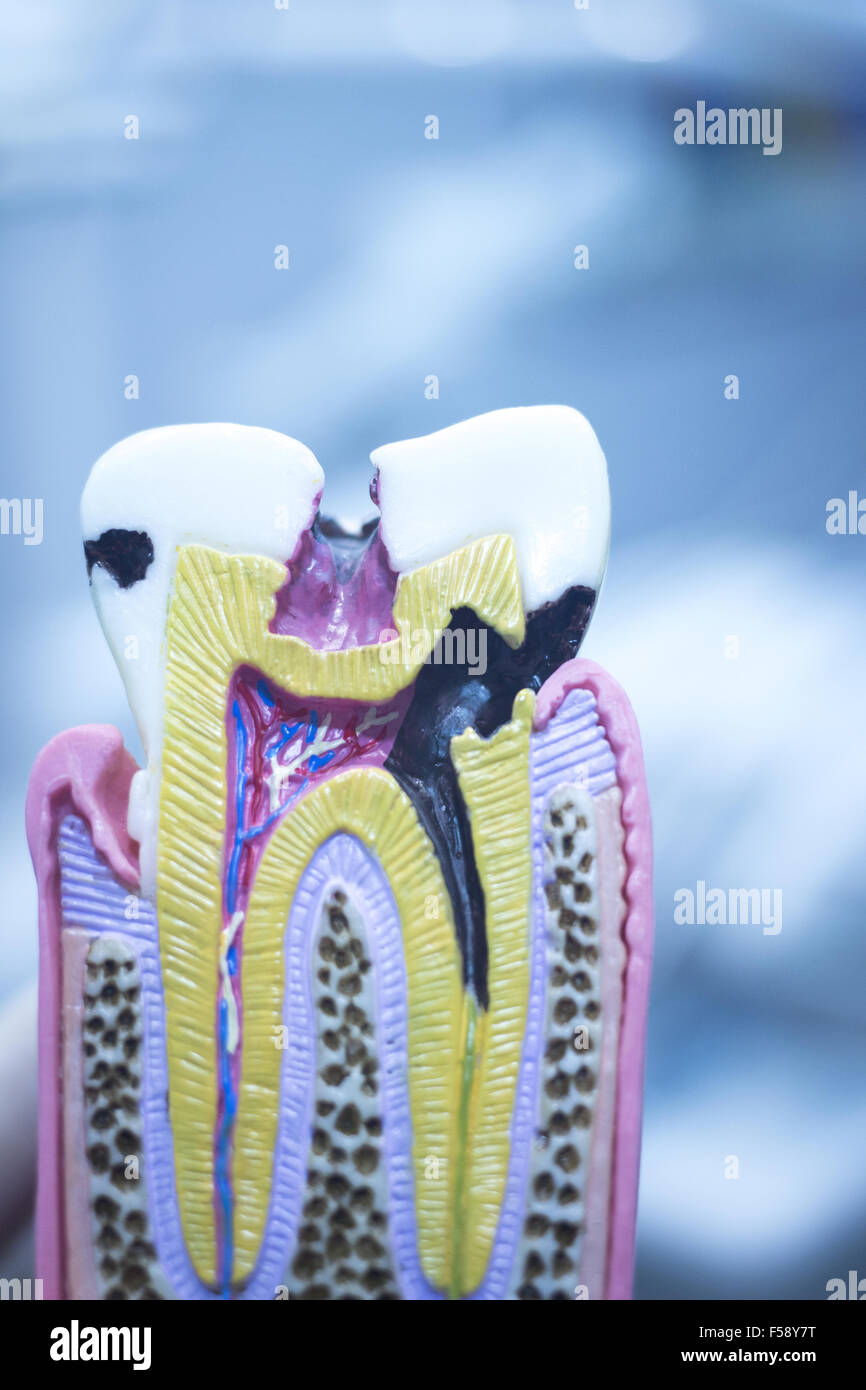 Dental tooth model cast showing decay casing pain, enamel and roots in ...