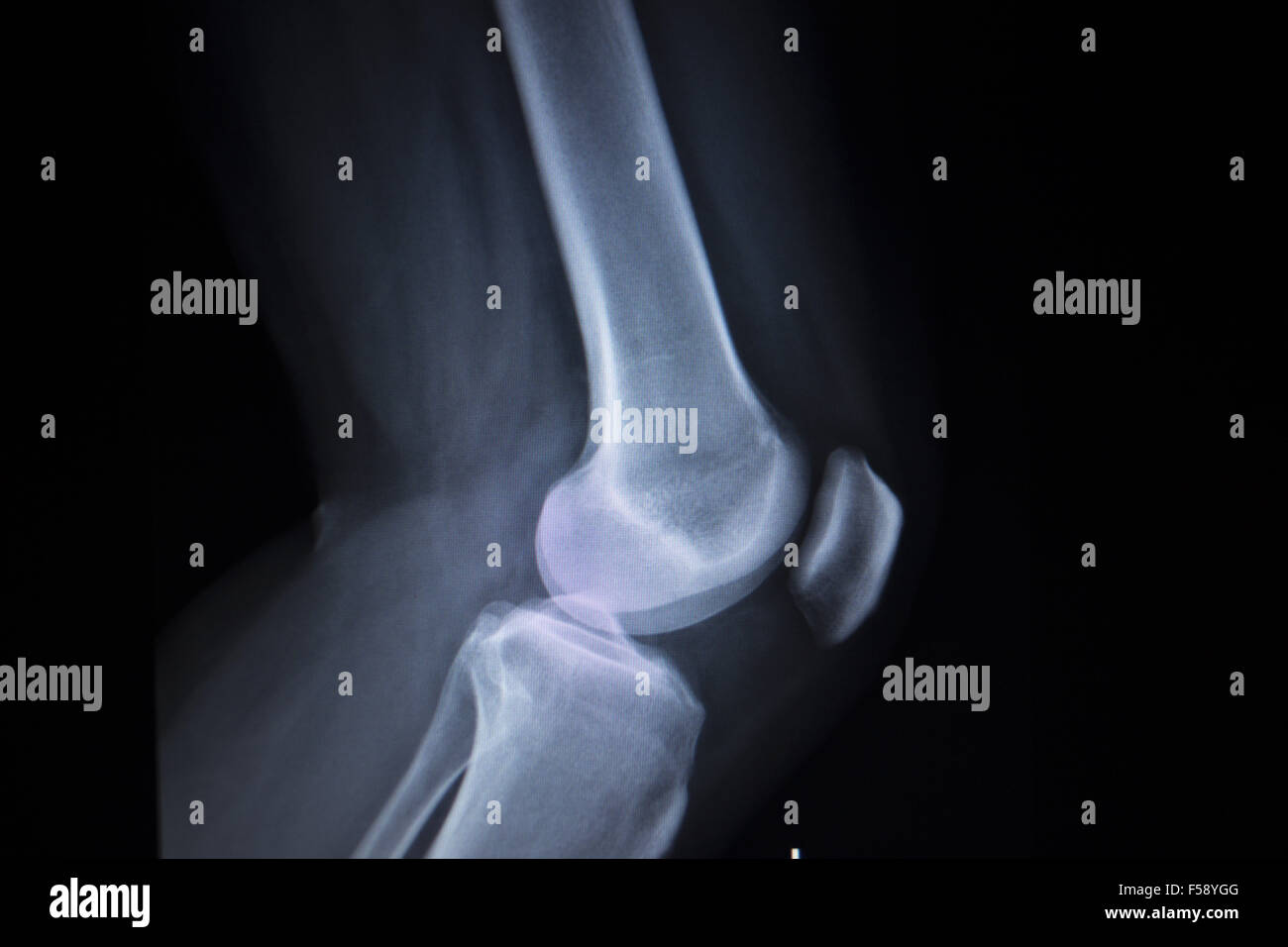 X-ray orthopedic medical CAT scan of painful knee meniscus injury leg ...
