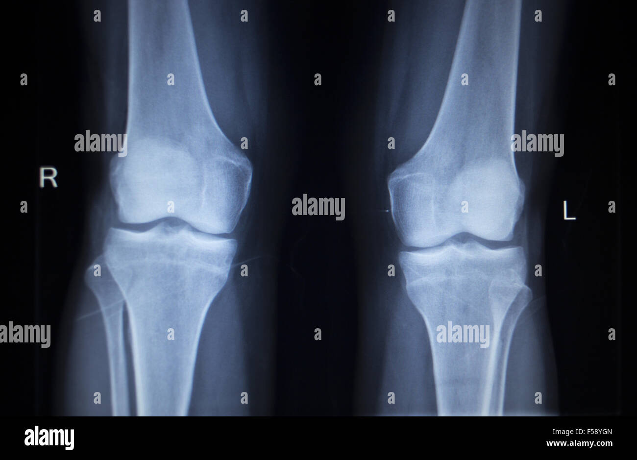 X-ray orthopedic medical CAT scan of painful knee meniscus injury leg ...
