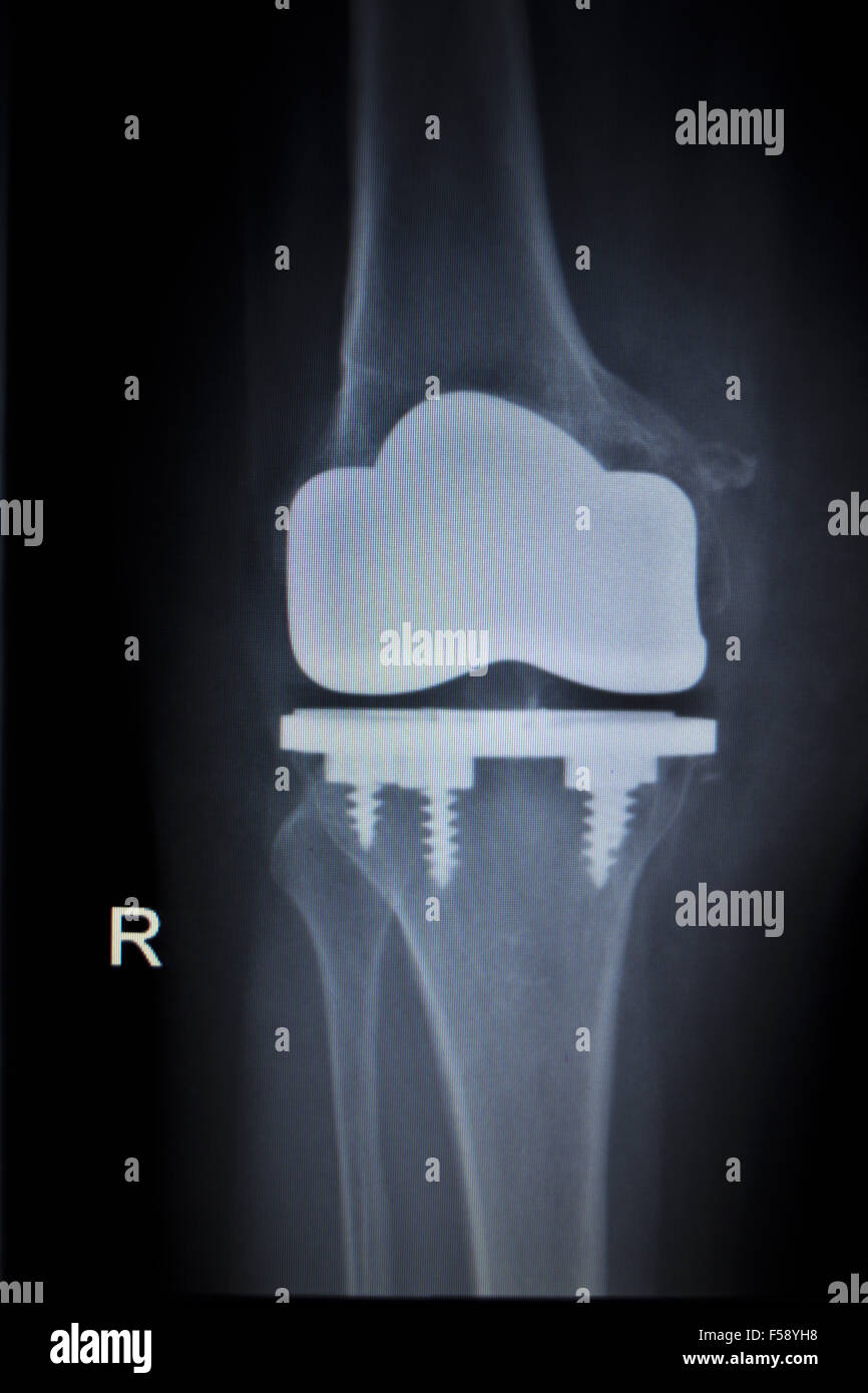 X-ray orthopedic medical CAT scan of painful knee meniscus injury leg ...