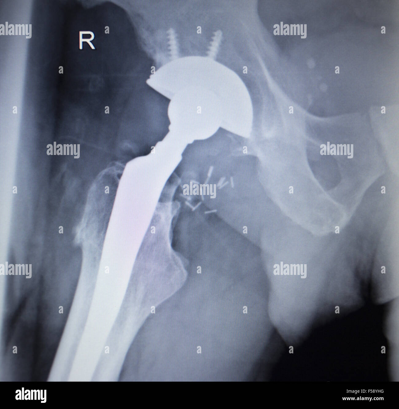 X-ray scan image of hip joints with orthopedic hip joint replacement ...