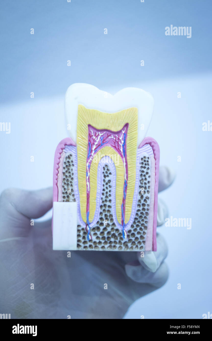 Dental tooth model cast showing decay casing pain, enamel and roots in ...