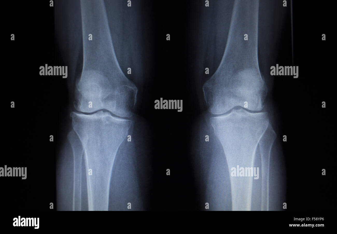 X-ray orthopedic medical CAT scan of painful knee meniscus injury leg ...