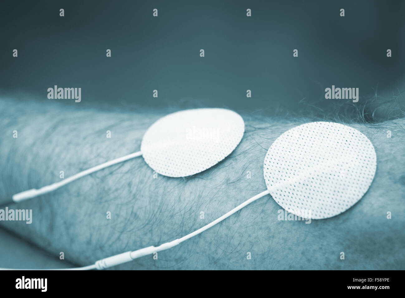 Patient hand arm wrist in electro physiotherapy electrical impulse ...