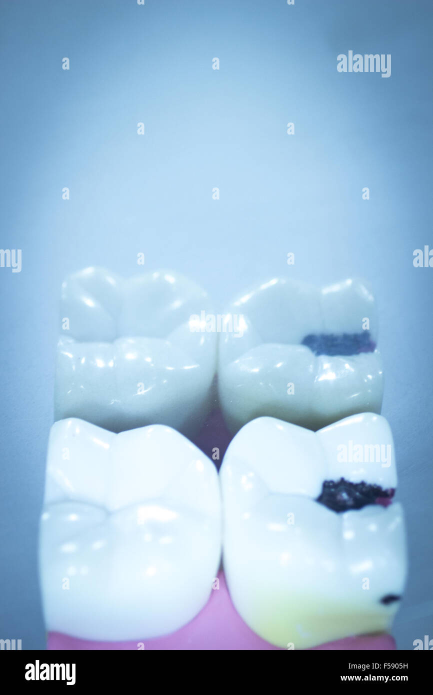 Dental tooth model cast showing decay casing pain, enamel and roots in ...
