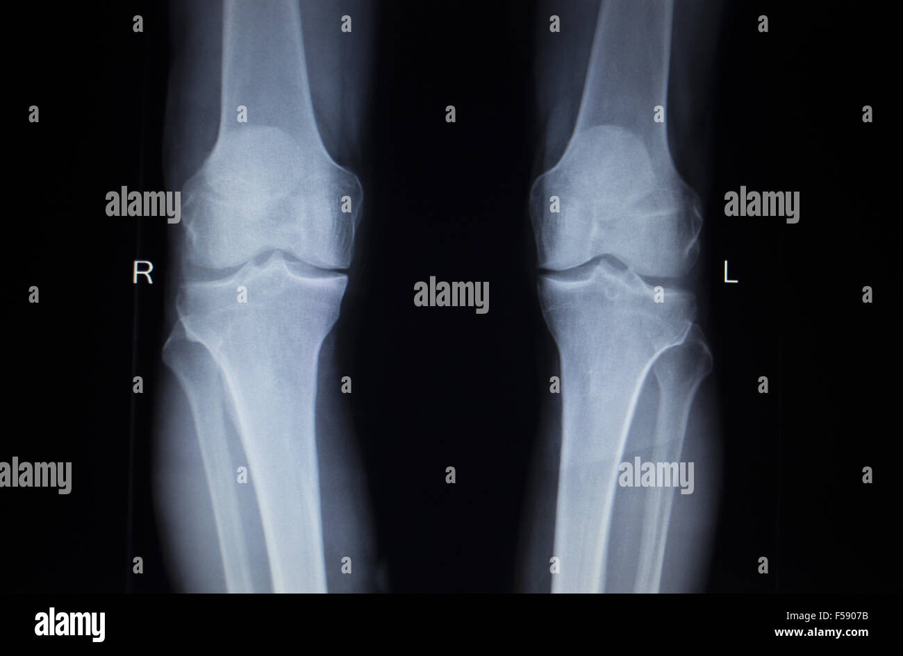 X-ray orthopedic medical CAT scan of painful knee meniscus injury leg ...
