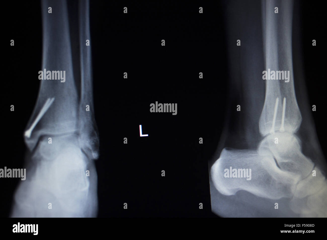 X-ray orthopedic medical CAT scan of painful ankle foot injury in ...