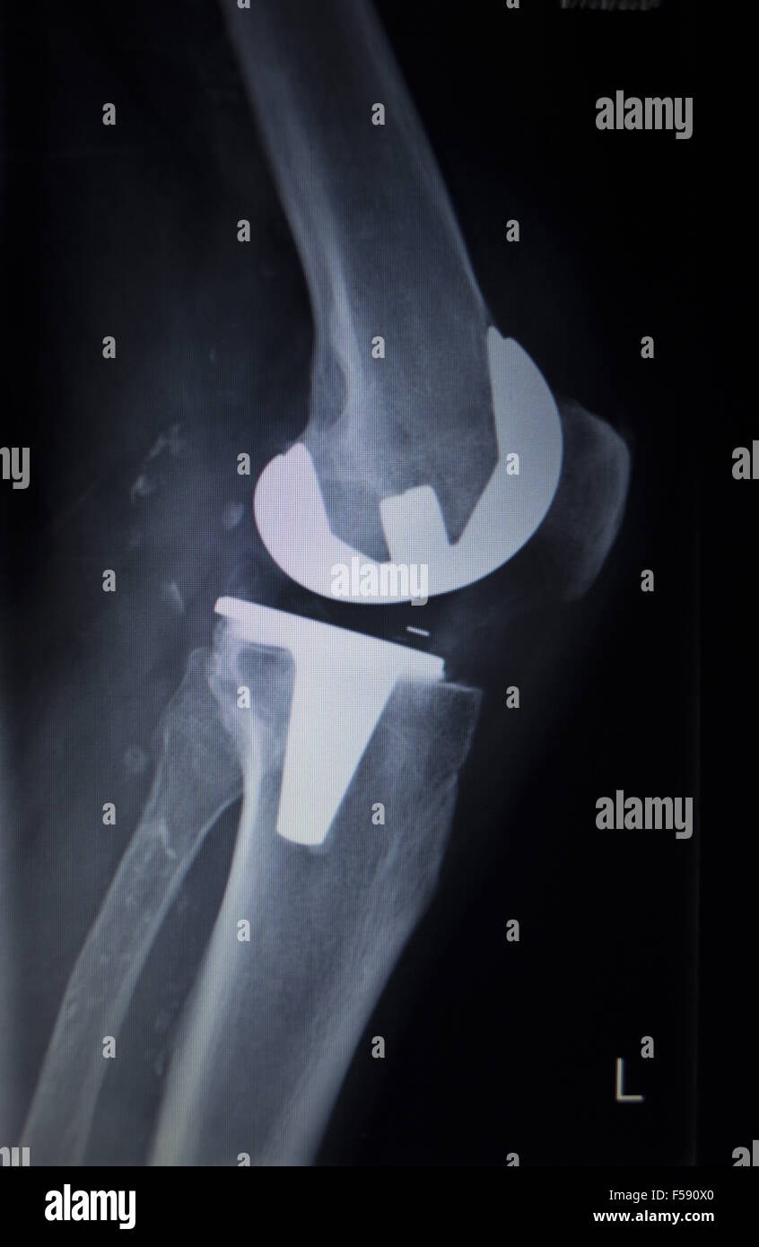 X-ray orthopedic medical CAT scan of painful knee meniscus injury leg ...