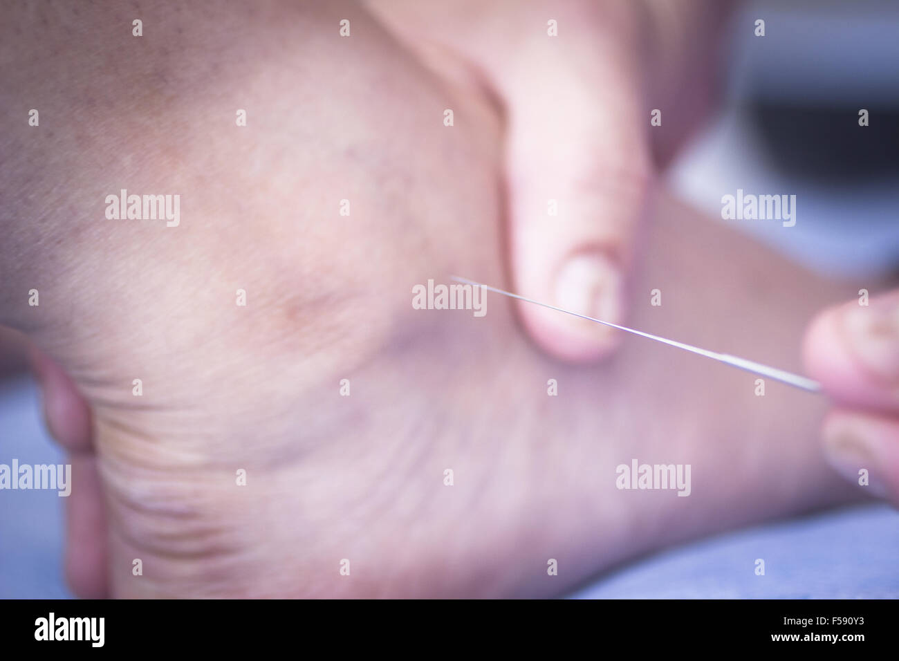 Doctor hand acupuncture needle young female patient arm real life photo ...