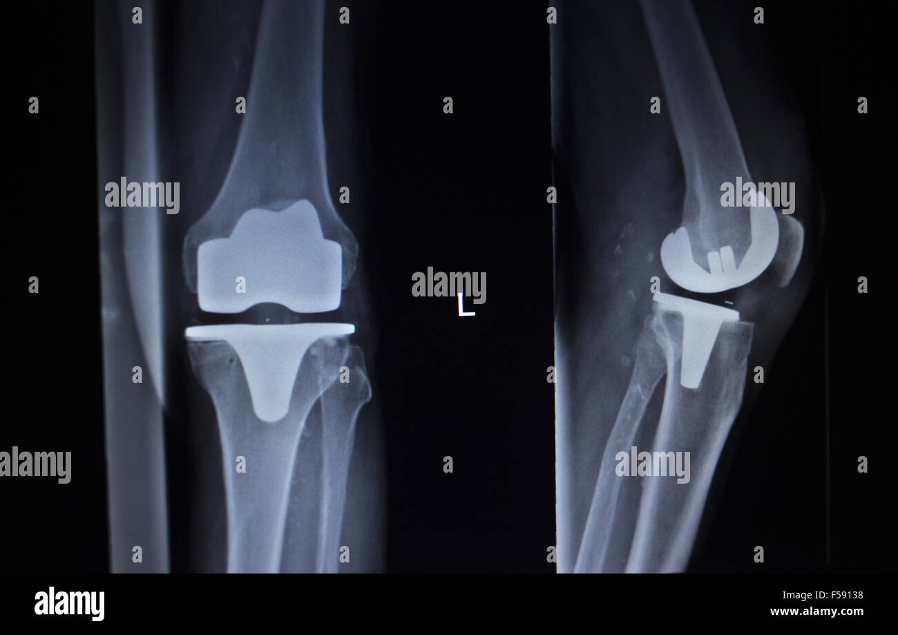 X-ray orthopedic medical CAT scan of painful knee meniscus injury leg ...