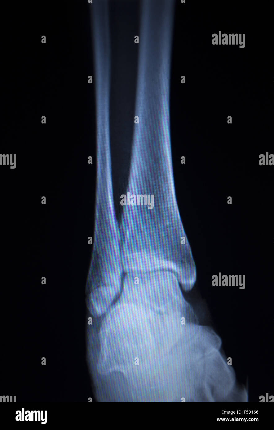 X-ray orthopedic medical CAT scan of painful ankle foot injury in ...
