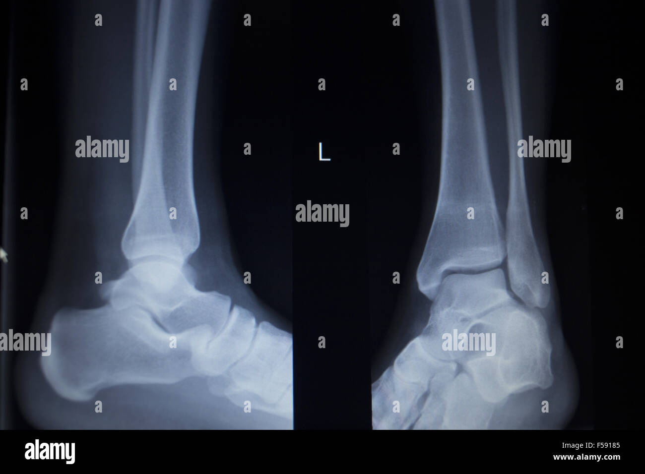 X-ray orthopedic medical CAT scan of painful ankle foot injury in ...