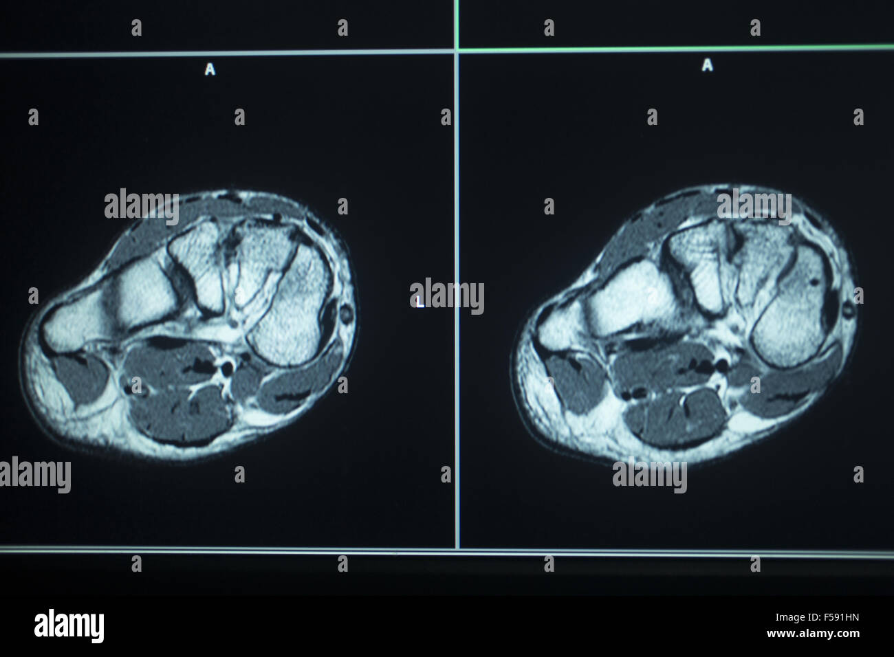 MRI magentic resonance imaging nuclear scanning scan test results foot ...