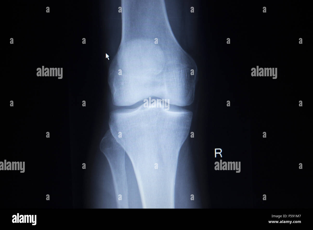 X-ray orthopedic medical CAT scan of painful knee meniscus injury leg ...