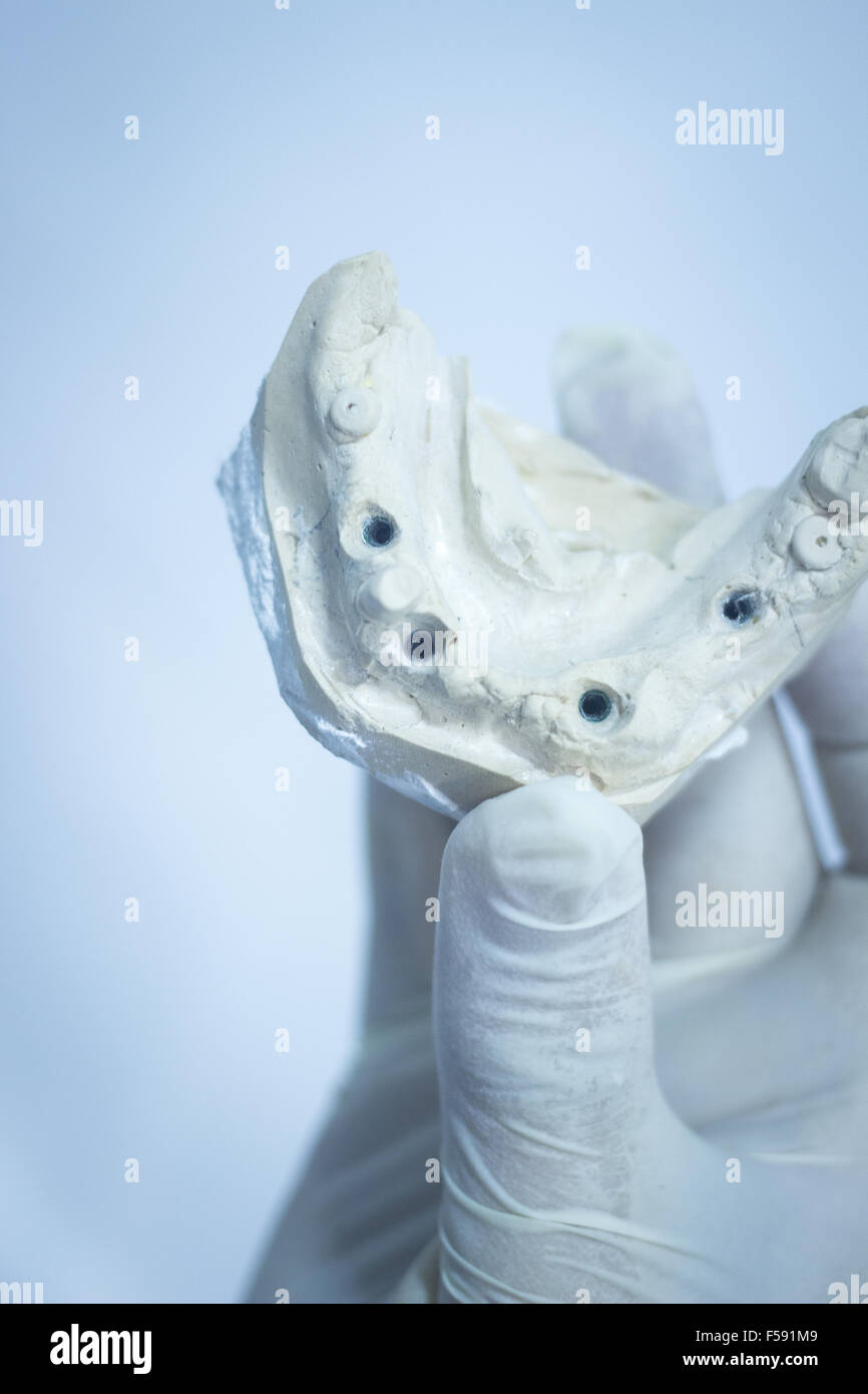 Dental mold dentist clay teeth plate ceramic cast model showing tooth ...