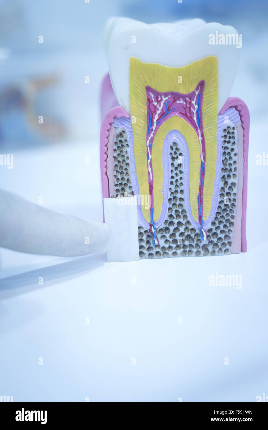 Dental tooth model cast showing decay casing pain, enamel and roots in ...