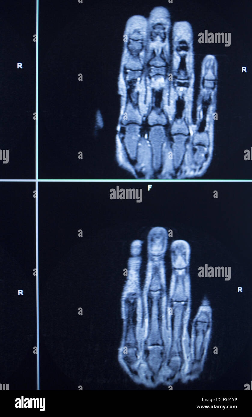MRI magentic resonance imaging nuclear scanning scan test results hand ...