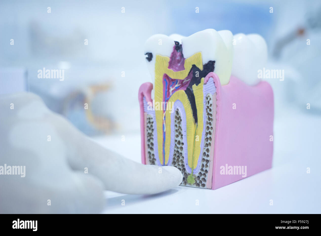 Dental tooth model cast showing decay casing pain, enamel and roots in ...