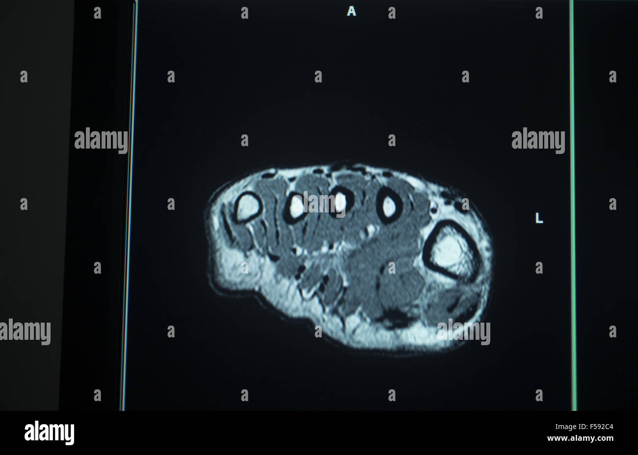 MRI magentic resonance imaging nuclear scanning scan test results foot ...