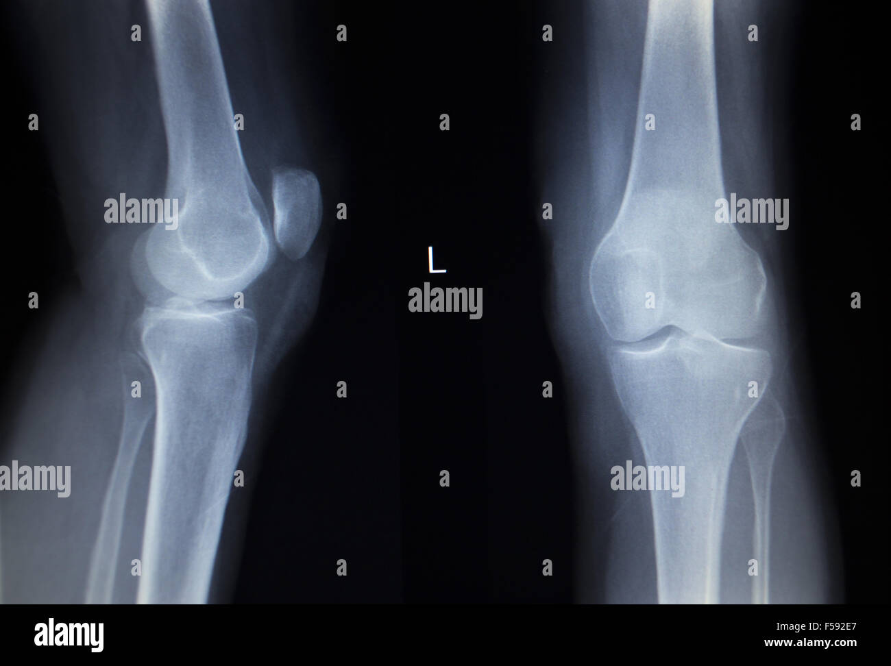 X-ray orthopedic medical CAT scan of painful knee meniscus injury leg ...
