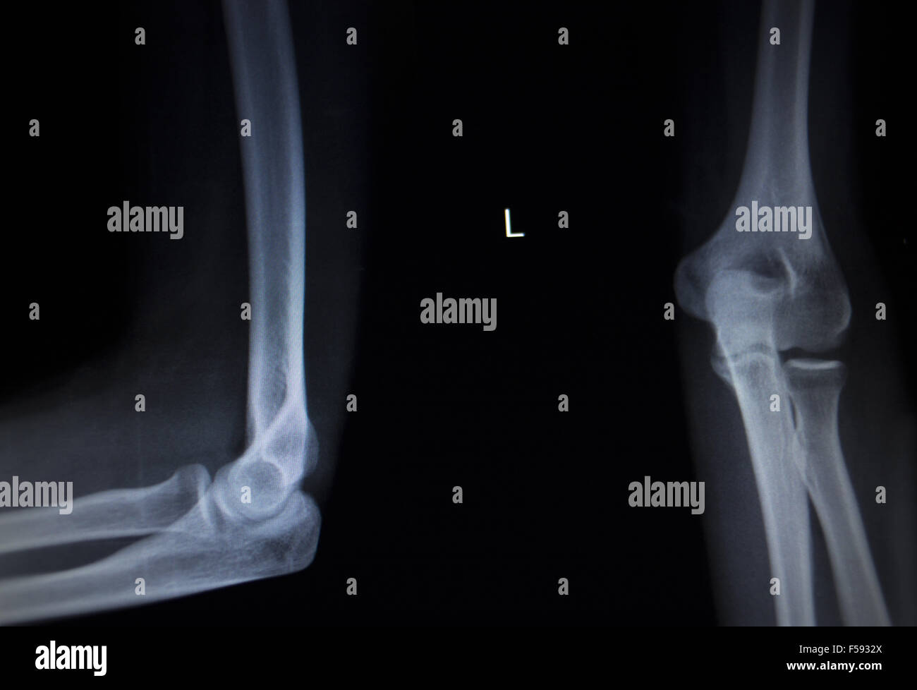 X-ray orthopedic medical CAT scan of painful tennis elbow injury in ...