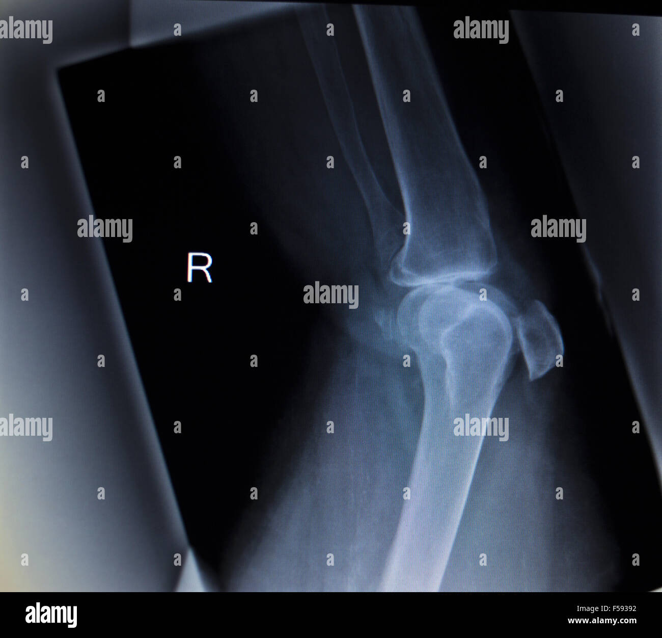 X-ray orthopedic medical CAT scan of painful knee meniscus injury leg ...