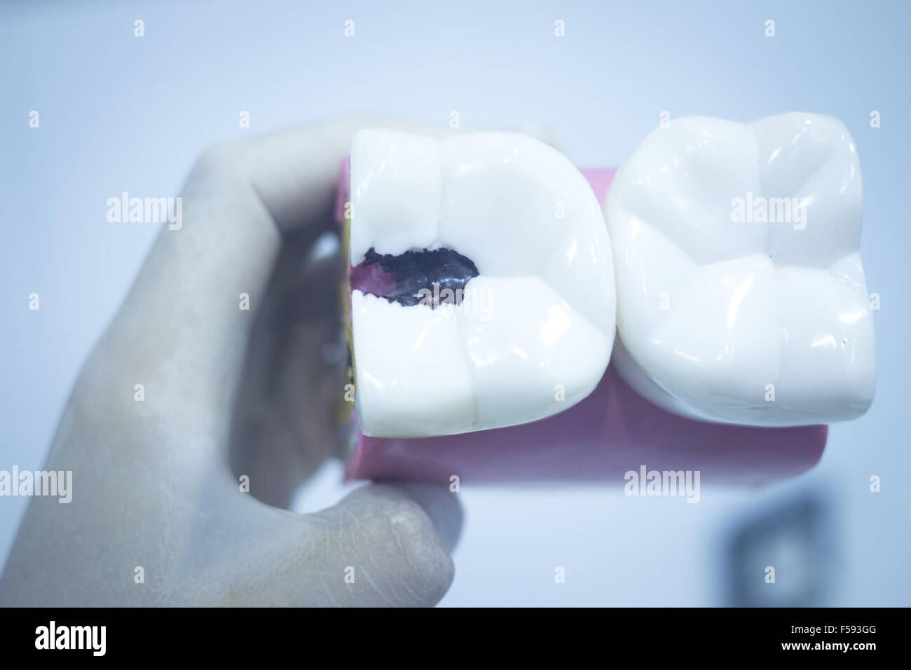 Dental tooth model cast showing decay casing pain, enamel and roots in ...