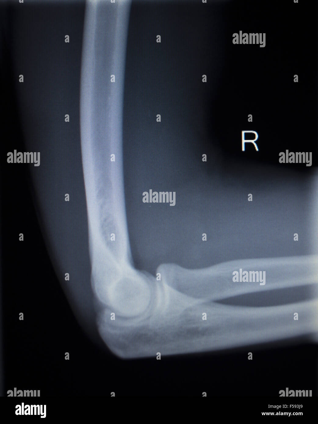 X-ray orthopedic medical CAT scan of painful tennis elbow injury in ...