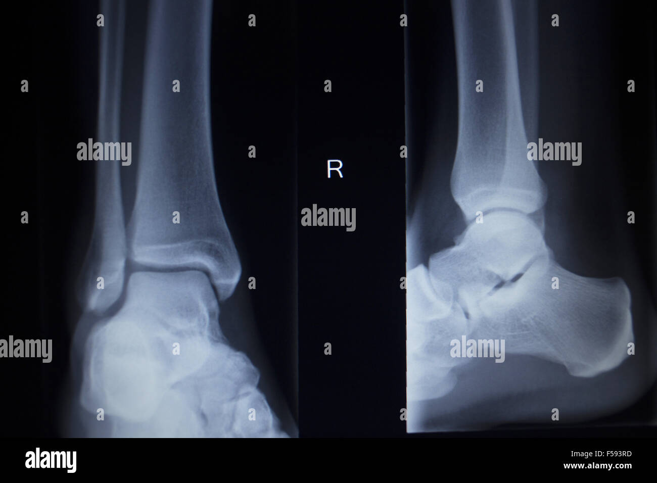 X-ray orthopedic medical CAT scan of painful ankle foot injury in ...
