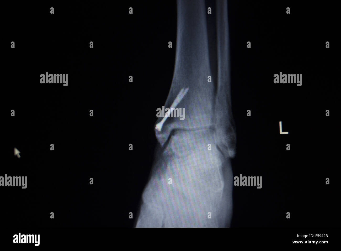 X-ray orthopedic medical CAT scan of painful ankle foot injury in ...
