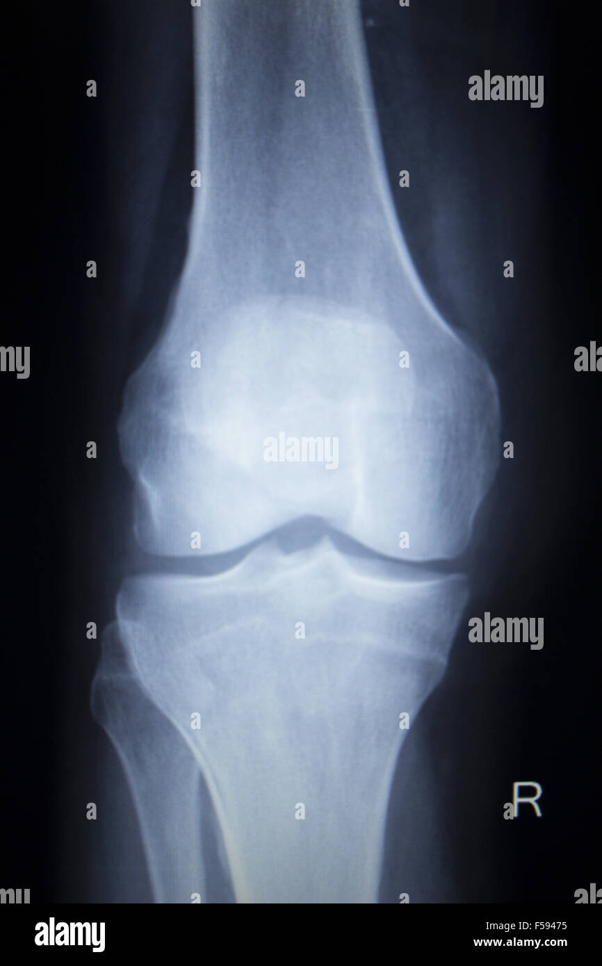 X-ray orthopedic medical CAT scan of painful knee meniscus injury leg ...
