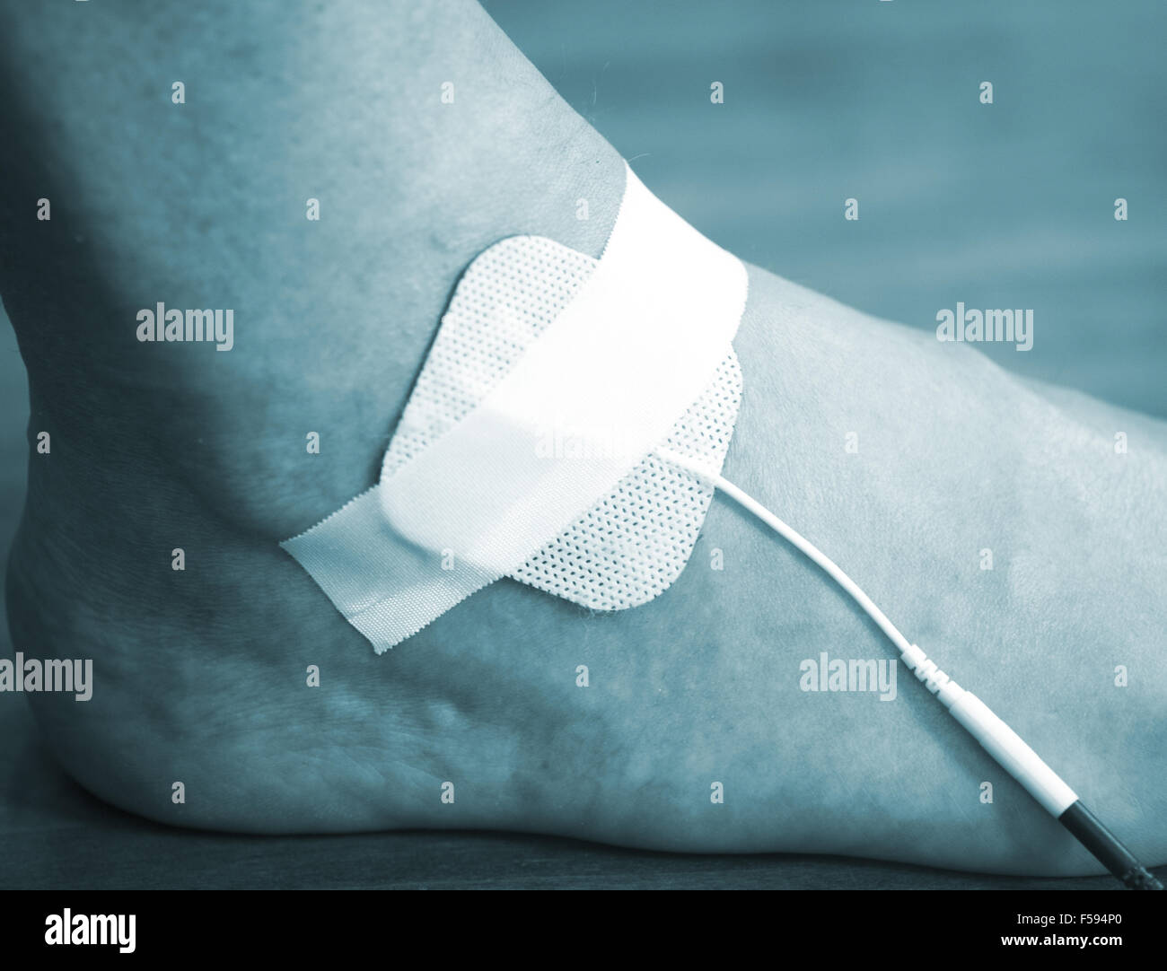 Patient hand arm wrist in electro physiotherapy electrical impulse ...