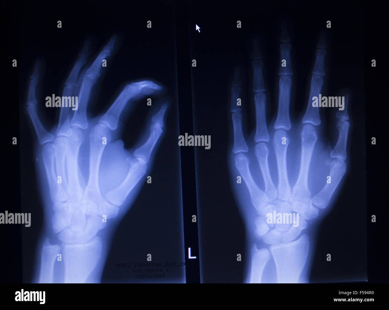 X-ray orthopedic medical CAT scan of painful hand fingers thumb injury ...
