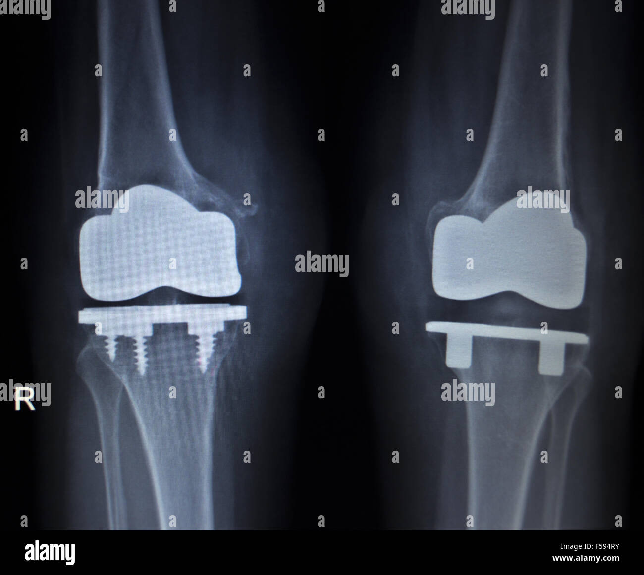 X-ray orthopedic medical CAT scan of painful knee meniscus injury leg ...