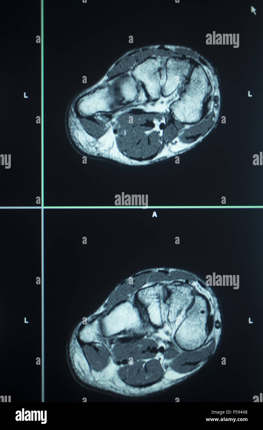 MRI magentic resonance imaging nuclear scanning scan test results foot ...