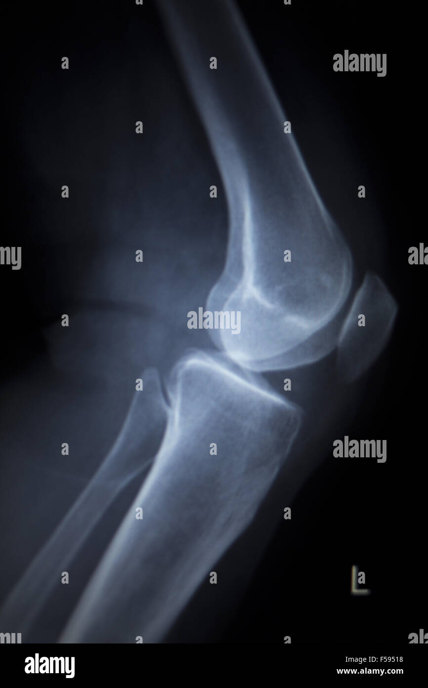 X-ray orthopedic medical CAT scan of painful knee meniscus injury leg ...