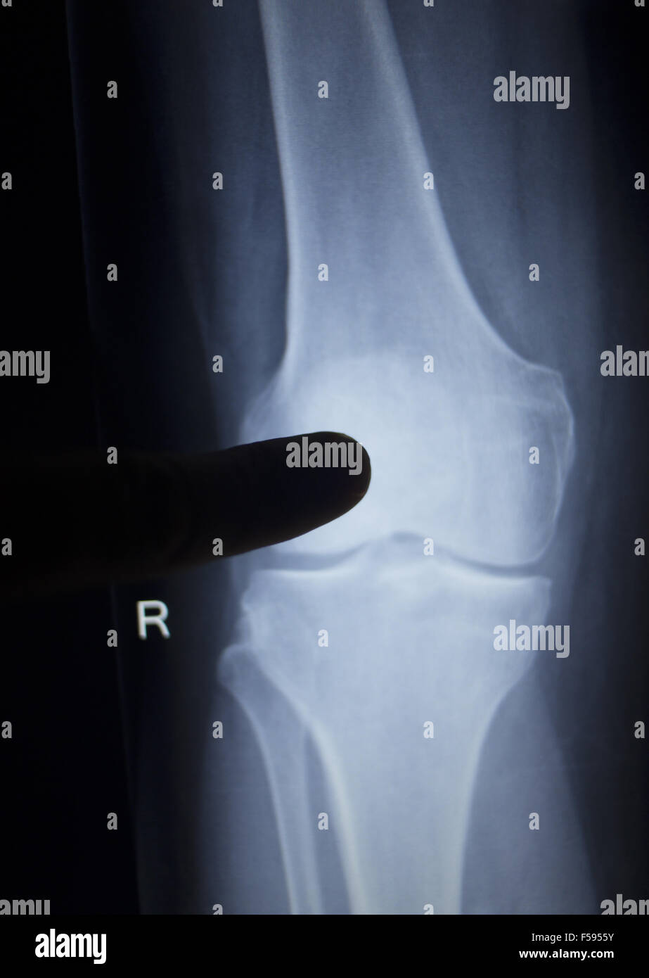 X-ray orthopedic medical CAT scan of painful knee meniscus injury leg ...