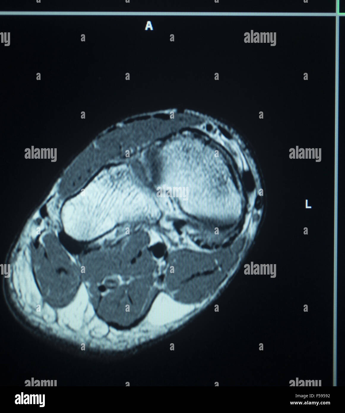 MRI magentic resonance imaging nuclear scanning scan test results foot ...