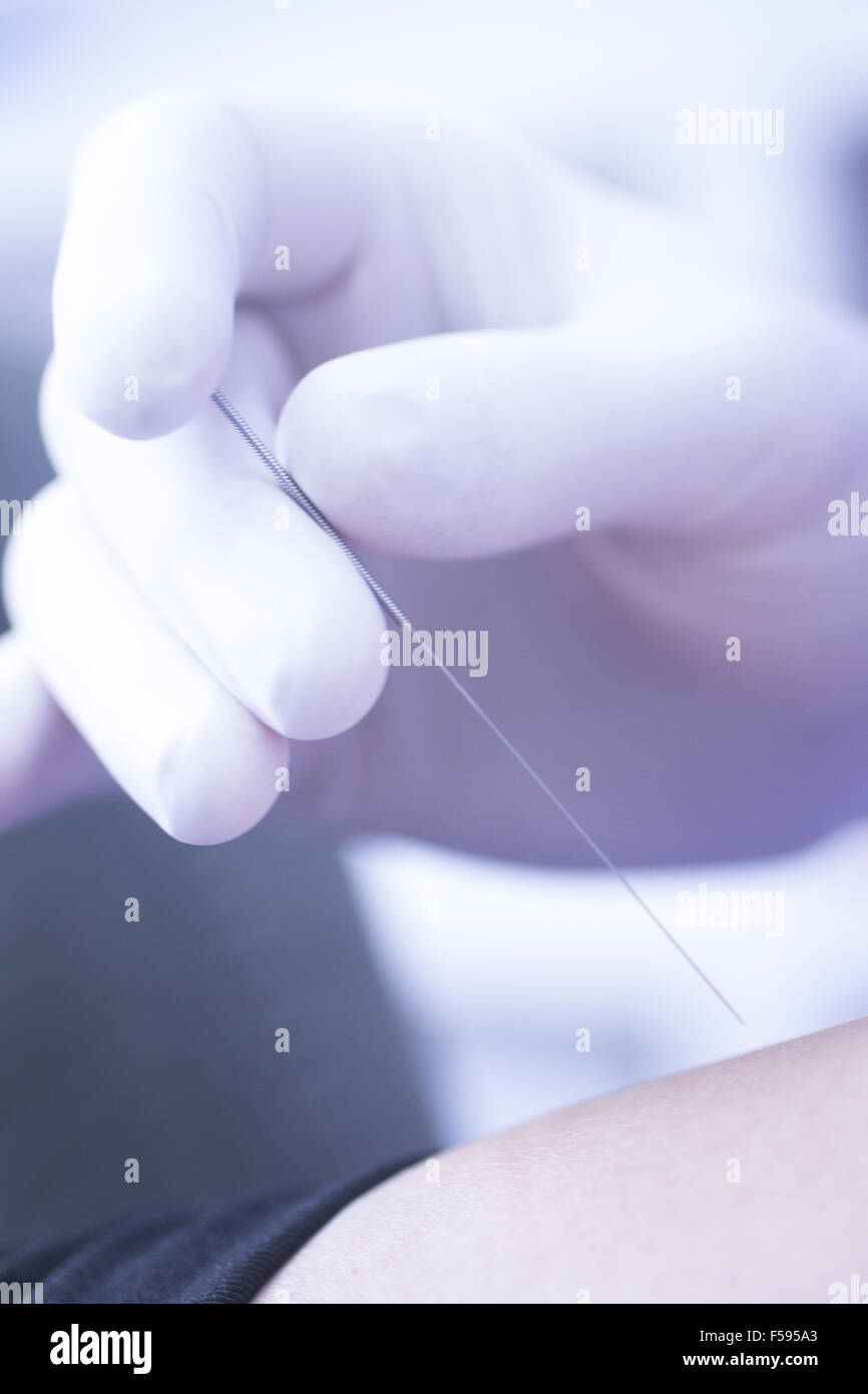 Doctor hand acupuncture needle young female patient arm real life photo ...