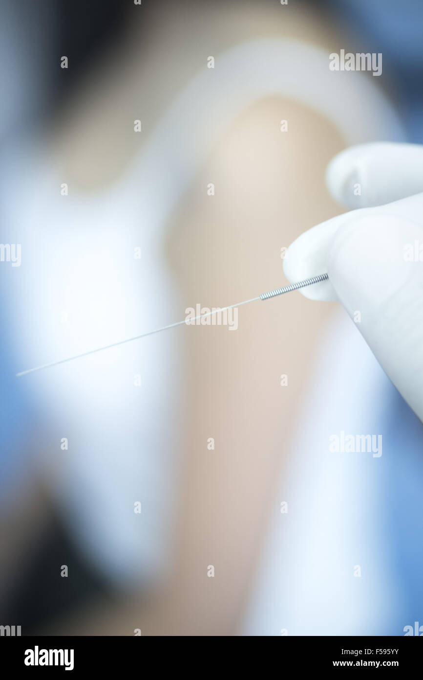 Doctor hand acupuncture needle young female patient arm real life photo ...