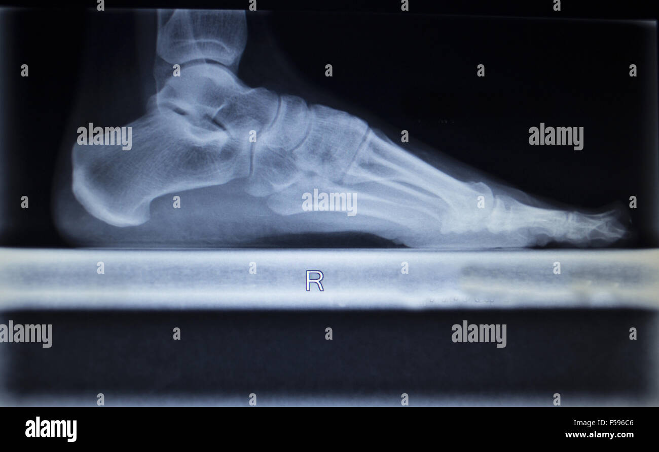 X-ray orthopedic medical CAT scan of painful foot injury in ...