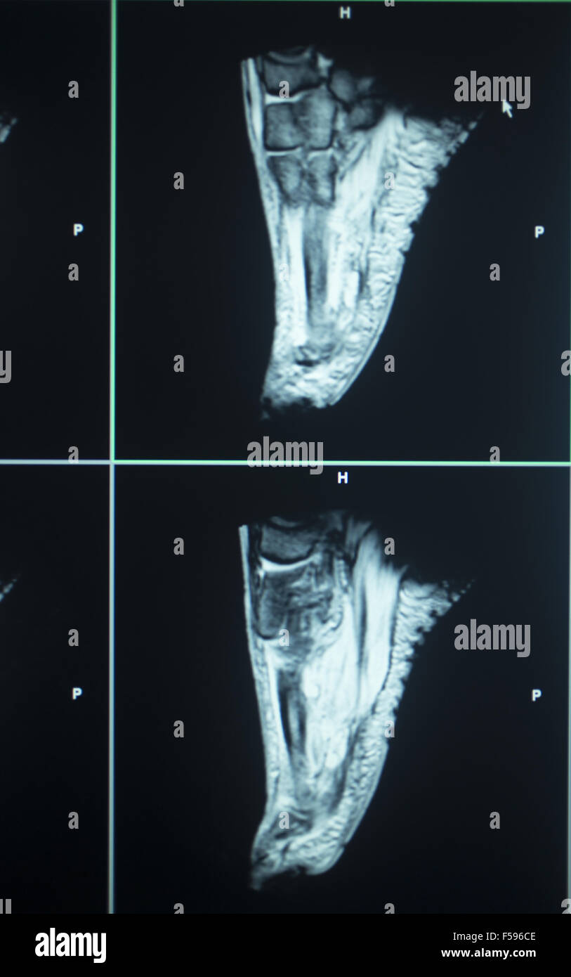 MRI magentic resonance imaging nuclear scanning scan test results foot ...